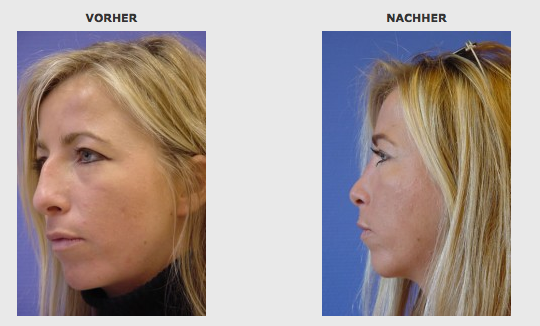 Rhinoplasty Journey: Prof. Dr. Werner Mang, Germany