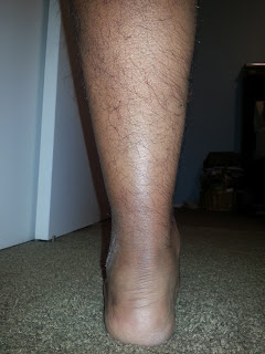 Peroneal Tendon Surgery Recovery: Ankle Time Line (updated for week 10/11)