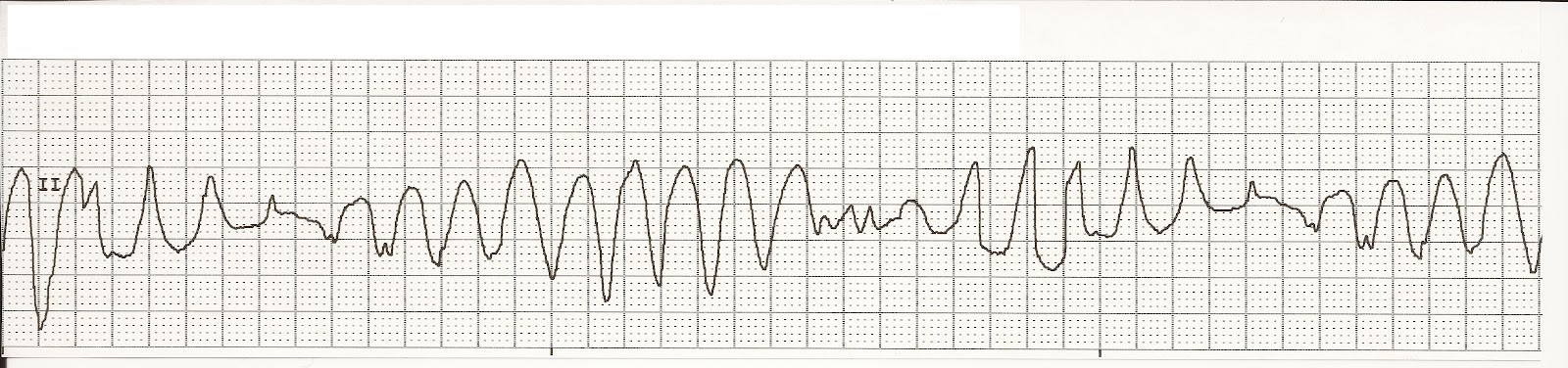 EKG Rhythm Strips 12- ventricular rhythms
