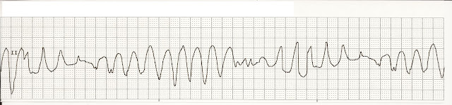 EKG Rhythm Strips 12- ventricular rhythms