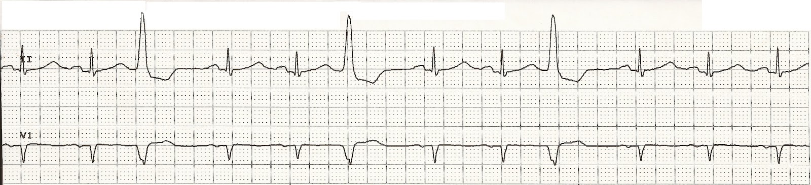 EKG Rhythm Strip Quiz 49