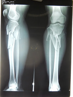 Orthopaedi Knowledges: MANAGEMENT OF LONG BONE FRACTURES