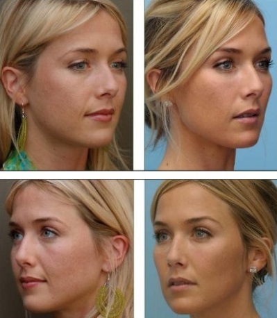 Before and after Botox - Cheek Enhancement, Nasolabial Dermafillers