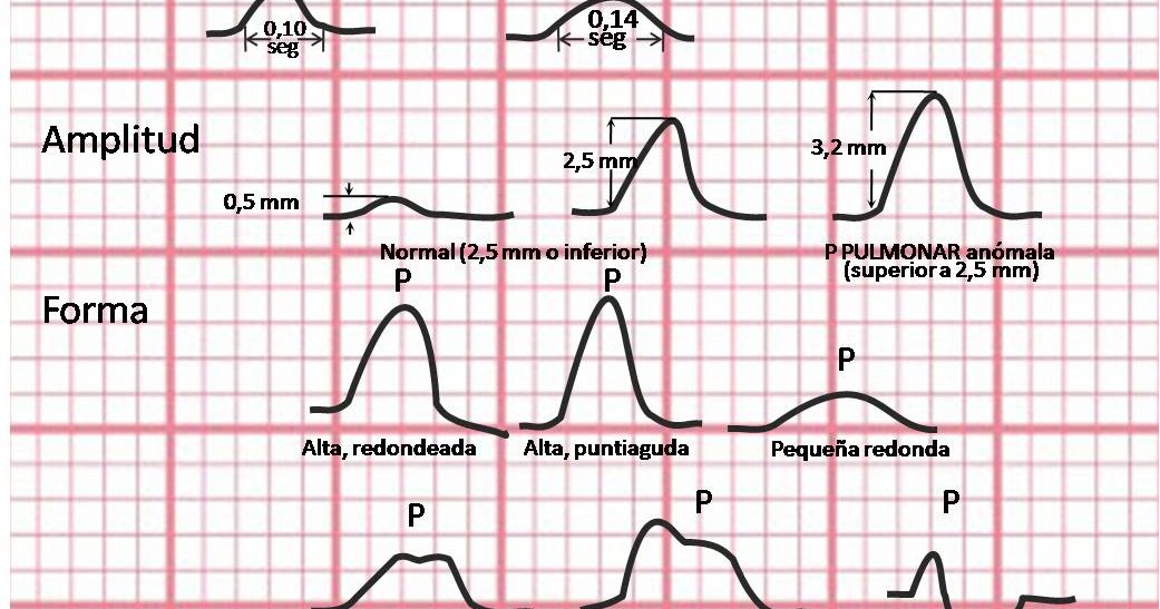 telemedicina EKG: morfología de la onda P