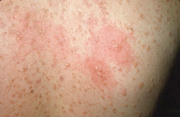 cara menghilangkan bintik-bintik merah di badan