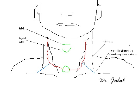 ENT made easy: TOTAL LARYNGECTOMY