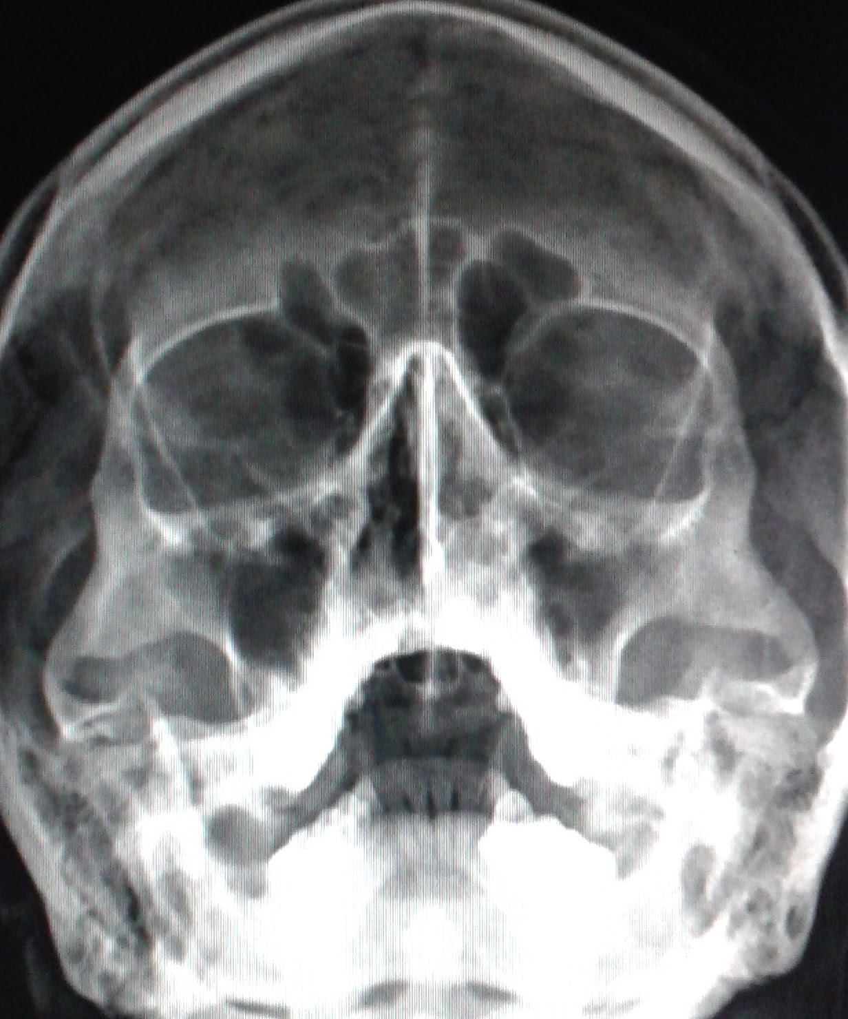 DICAS DE RADIOLOGIA: COMO AVALIAR A QUALIDADE DA RADIOGRAFIA DE SEIOS ...