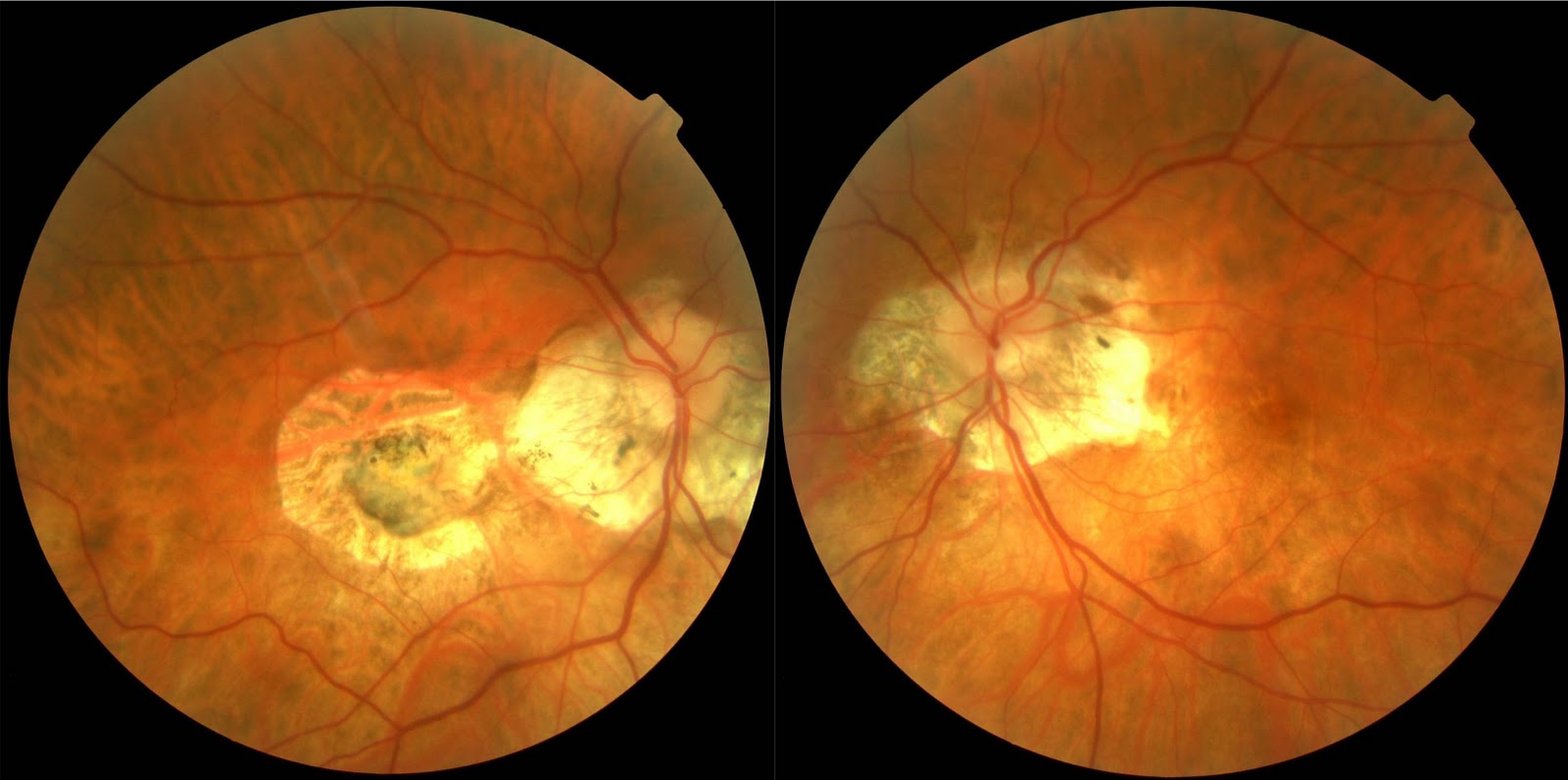 ESPACIO RETINA: Fondo miope.