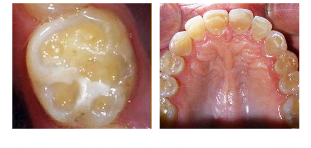 Las bebidas isotónicas (uso deportivo) y sus efectos dentales