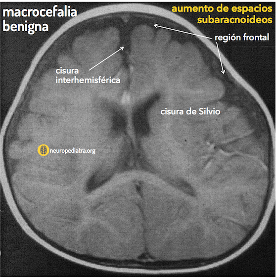 Enfermería Infantil: Macrocefalia