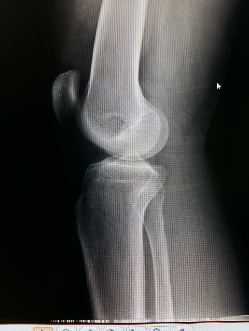 O R T O C R I T I C A: MENISCOPATIA POST TRAUMATICA