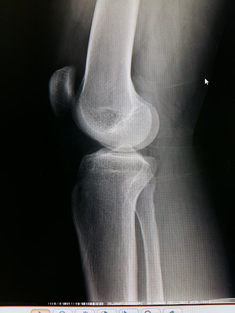 O R T O C R I T I C A: MENISCOPATIA POST TRAUMATICA