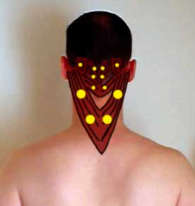 ARES Kinesiology Tape: Arestape Applications - Posterior Neck Pain