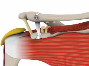 Indiaorthosurgeon: Acromioclavicular joint (AC) Disruption