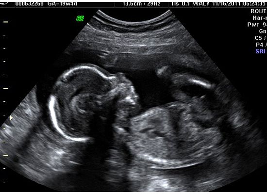 The Whaleys: 20 week anatomy scan