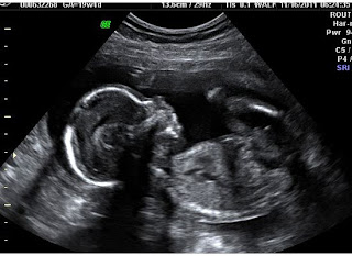 The Whaleys: 20 week anatomy scan