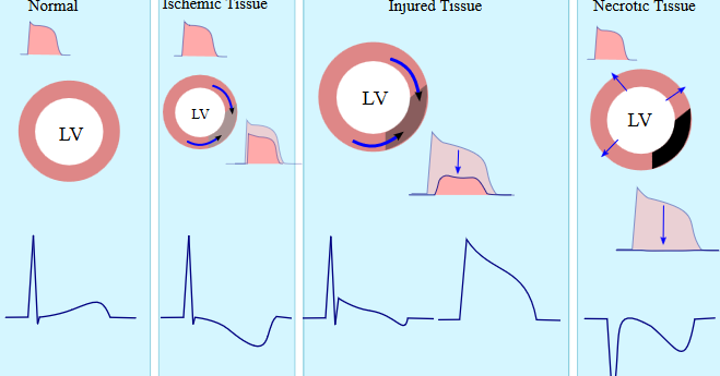 Morfologi Gelombang ST