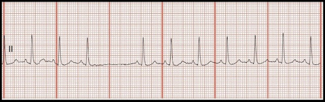 Practice EKG Rhythm Strips 218