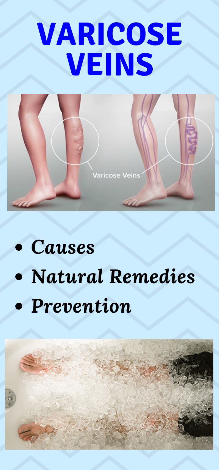 Natural Health Advice: Varicose Veins: Causes, Natural Remedies and ...