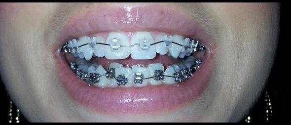 Becky's Braces Journey