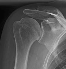 UW Shoulder and Elbow Academy: The Axillary view = the 'truth' view