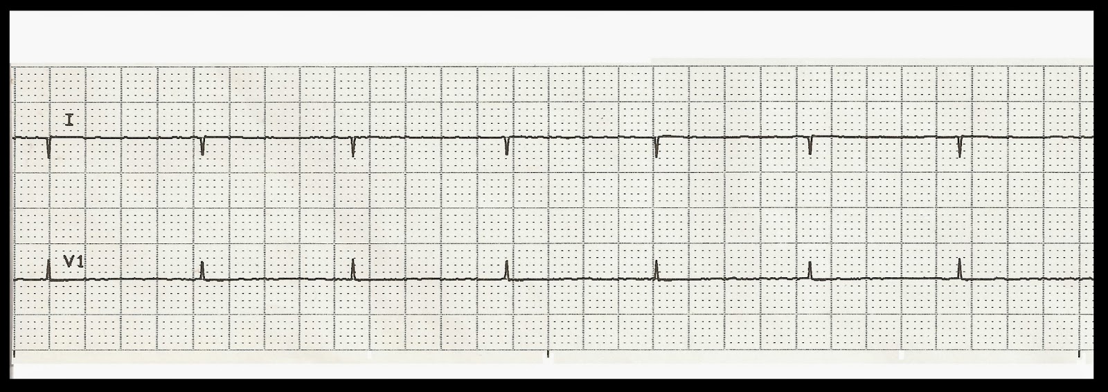 Practice EKG Rhythm Strips 211