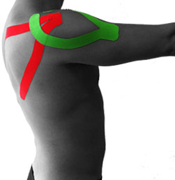ARES Kinesiology Tape: Frozen Shoulder