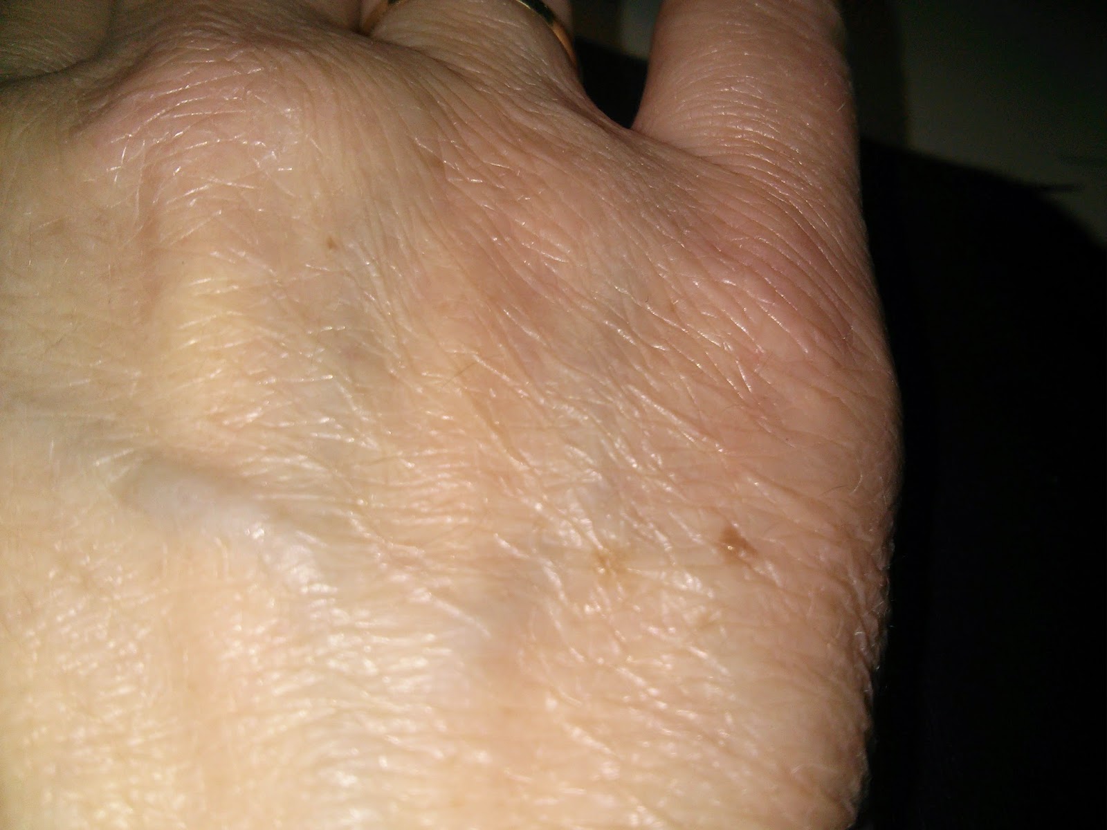 Historia de mi enfermedad: Alergias, inflamaciones, sarpullidos y moratones