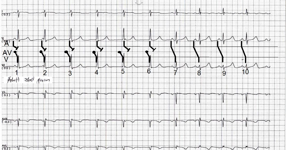 ECG Channel: AV dissociation