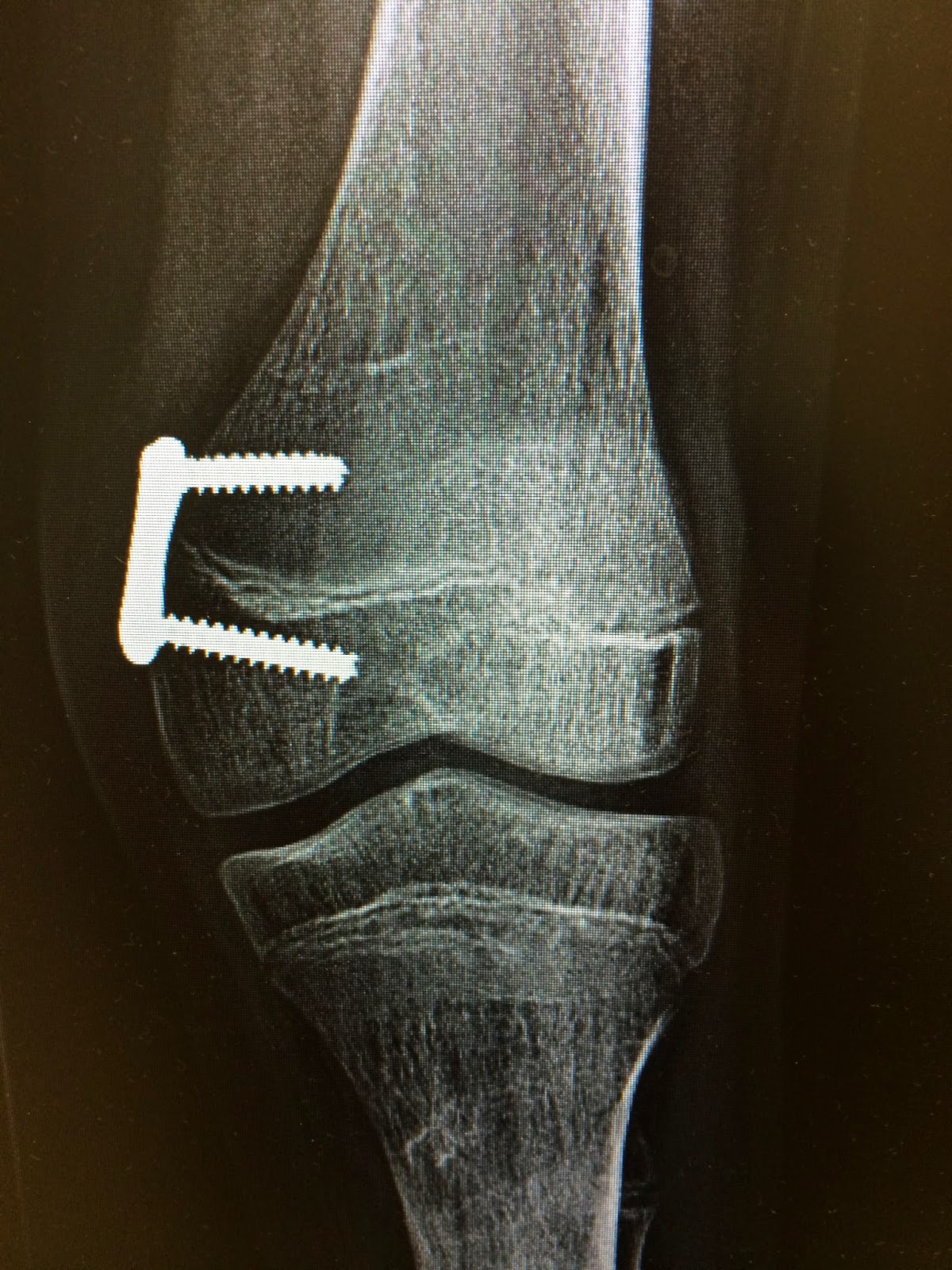 fibular hemimelia leg lengthening: Pin Removal and Walking Cast