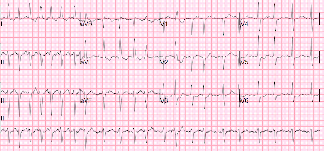 Dr. Smith's ECG Blog: Atrial Fib and RVR with a run of wide complex ...