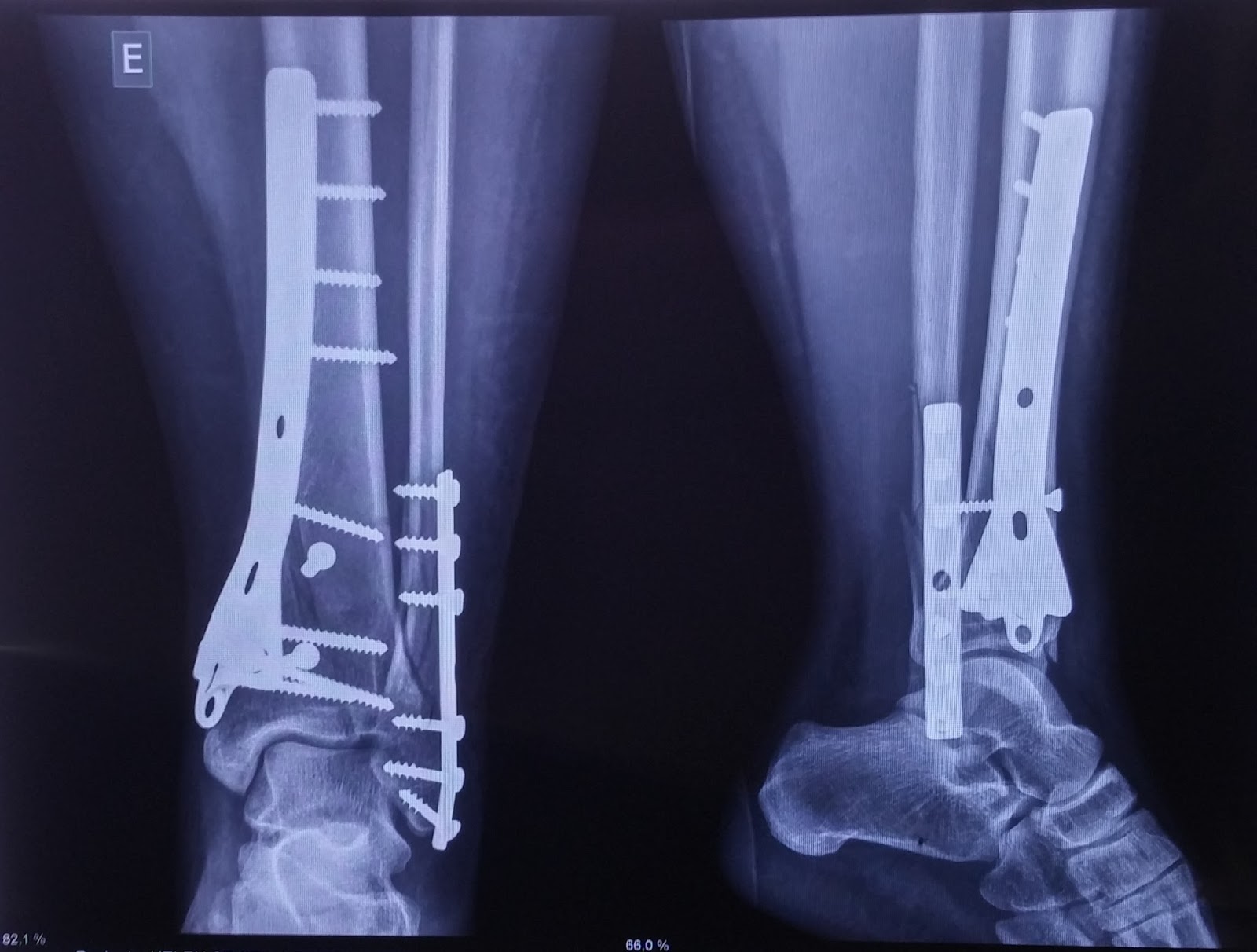 FRATURA TÍBIA E FÍBULA - ACIDENTE, RECUPERAÇÃO E RECOMEÇO