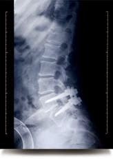 Medical Treatment Pictures-for Better Understanding: Back Surgery ...