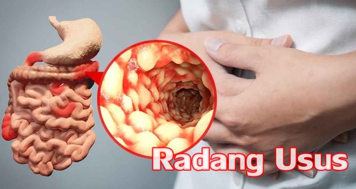 Khasiat dan Manfaat Jelly Gamat QnC Untuk Radang Usus ~ Jelly Gamat Manfaat