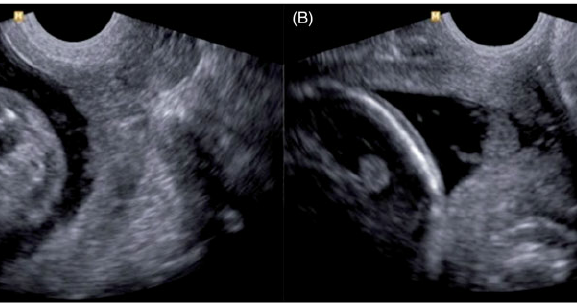 Ob/Gyn Updated : Intra-amniotic debris linked to Preterm Birth ...