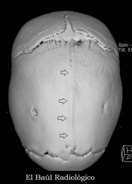 El Baúl Radiológico: CRANEOSINOSTOSIS. CIERRE PREMATURO DE LAS SUTURAS ...