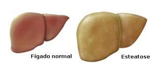 Uma enfermagem de 1ª qualidade à alcance de todos: ESTEATOSE HEPÁTICA