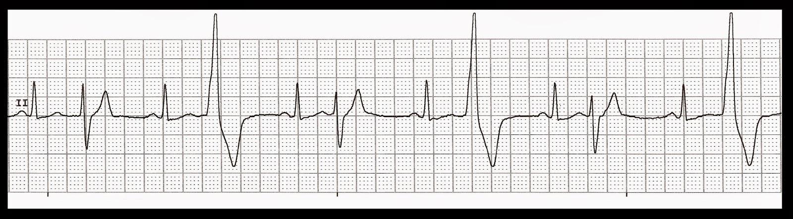 EKG Rhythm Quiz 236