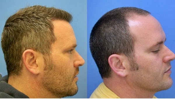 Understanding Frontal Hair Loss - African Hairstyle 2015