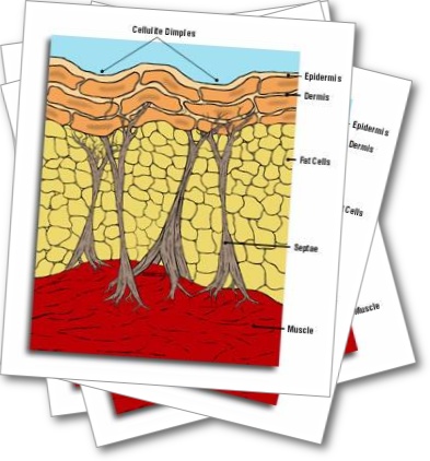 Tips And Remedies: Cellulite