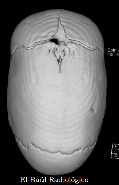 El Baúl Radiológico: CRANEOSINOSTOSIS. CIERRE PREMATURO DE LAS SUTURAS ...