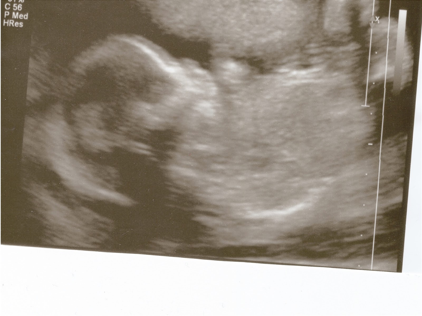 Our Journey through Embryo Adoption!: 18 week update