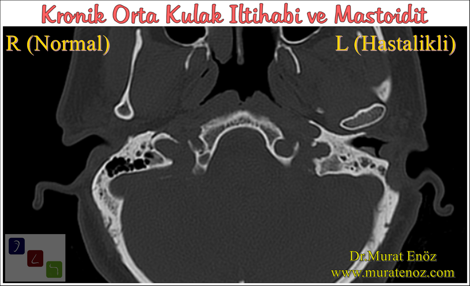 Kronik Orta Kulak İltihabı ve Mastoidit