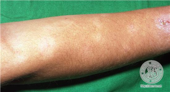 Pitiriasis versicolor