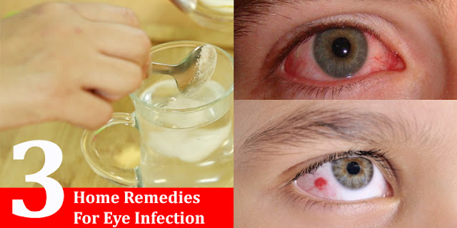 How To Treated Eye Infections At Home - Home Remedies For Eye ...