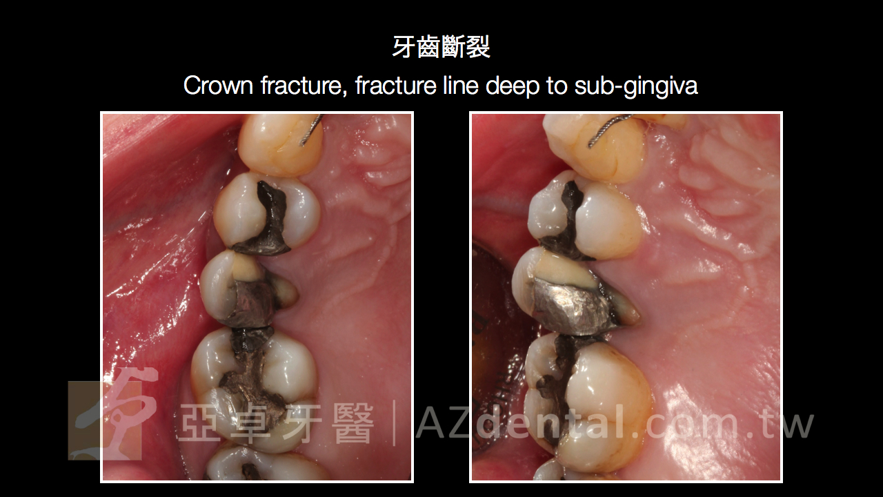 ・城東牙醫_陳政佑醫師・部落格: 立即植牙合併齒脊法上顎竇增高術 immediate implantation with osteotome ...