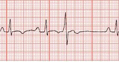 EKG Rhythm Strips: Bigeminy, Trigeminy, Quadrageminy