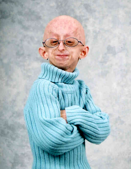 progeria syndrome ~ Christine O'Donnell