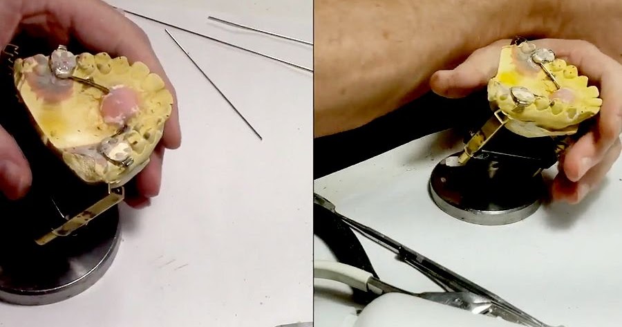 ORTHODONTICS: Nance Button Space Maintainer - Odonto-Tv