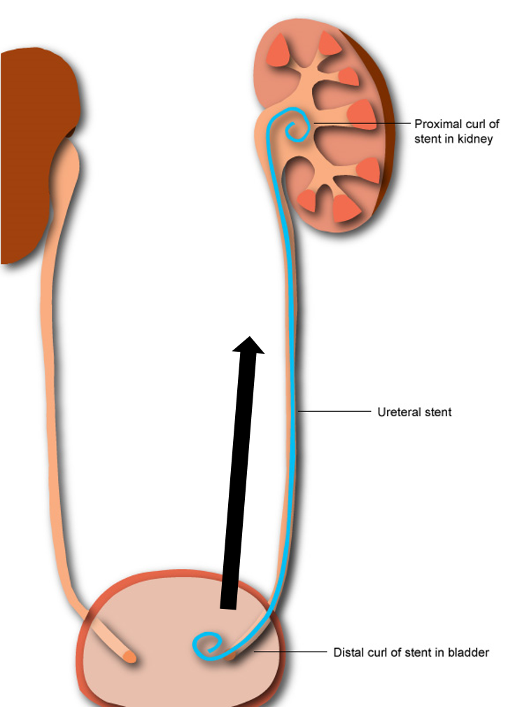Brady Urology at Johns Hopkins Hospital: Ureteral Stents: Necessarily a ...